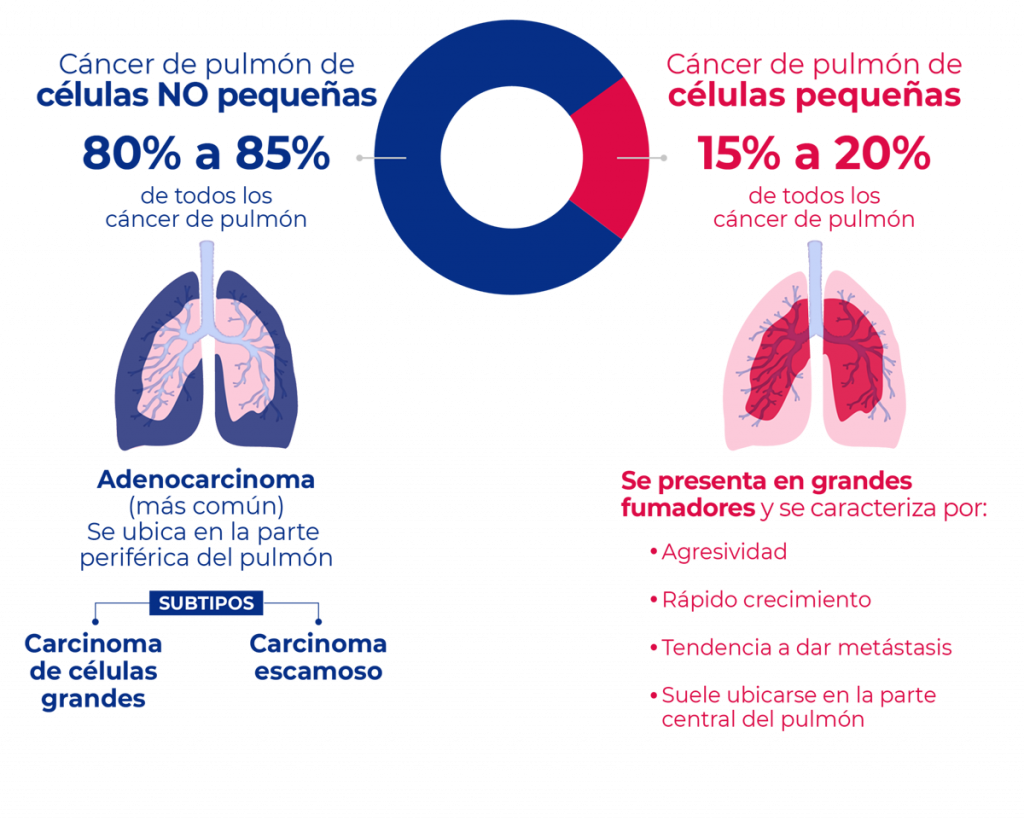 Tipos de Cáncer de Pulmón : Clínica Ciudad del Mar Tipos de Cáncer de Pulmón : Clínica Ciudad del Mar