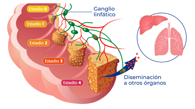 Diagnóstico y Etapificación : Clínica Ciudad del Mar