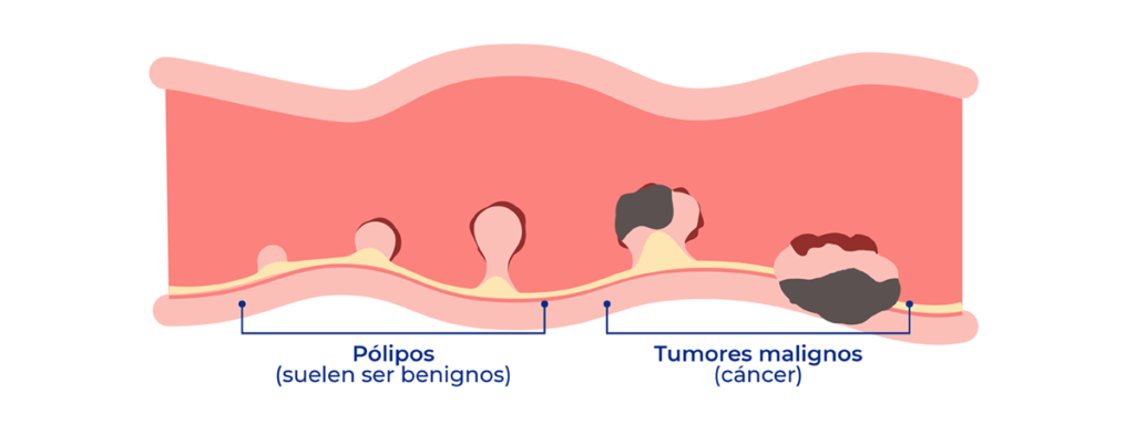 Entendiendo mi Cáncer Colorrectal – Desarrollo de Pólipos : Clínica ...