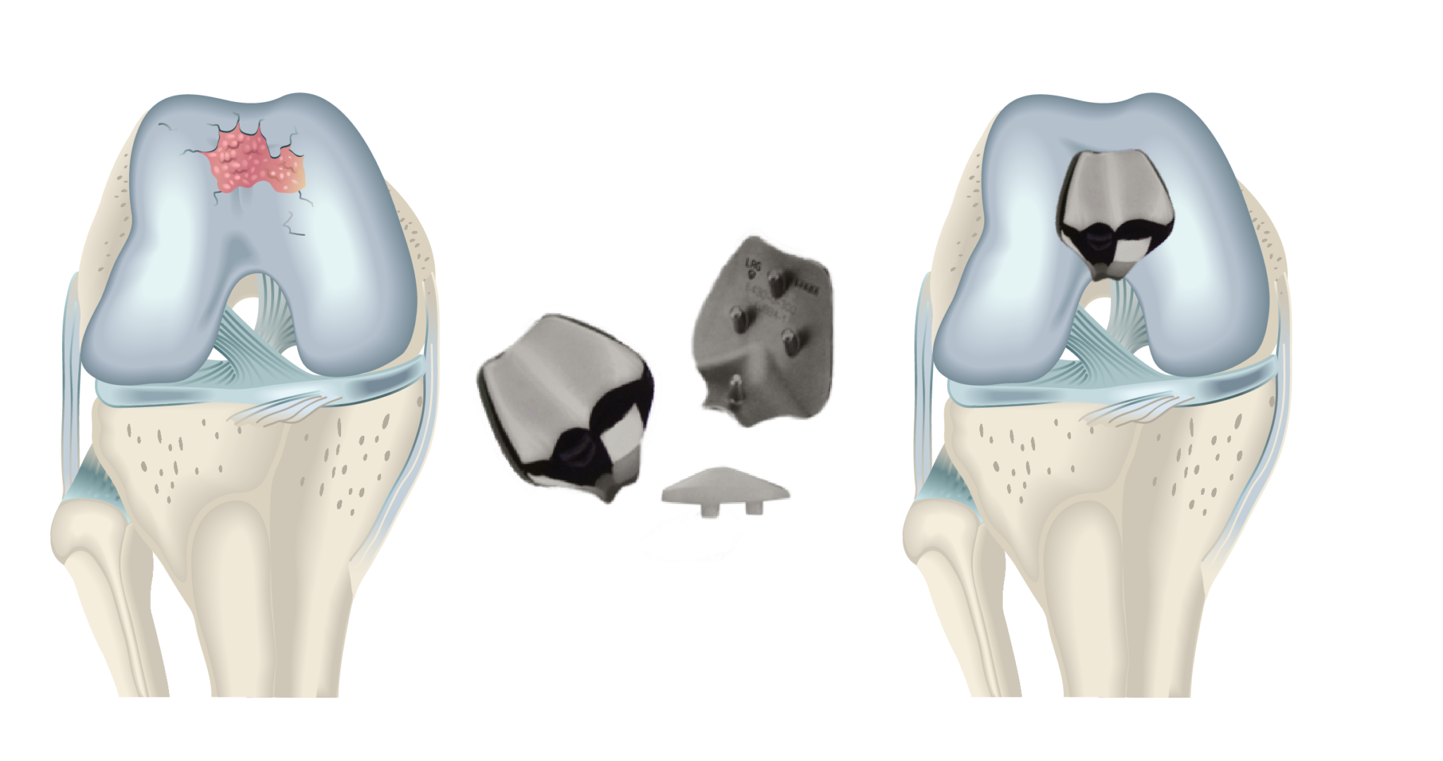 Patologías Degenerativas : Clínica Ciudad del Mar